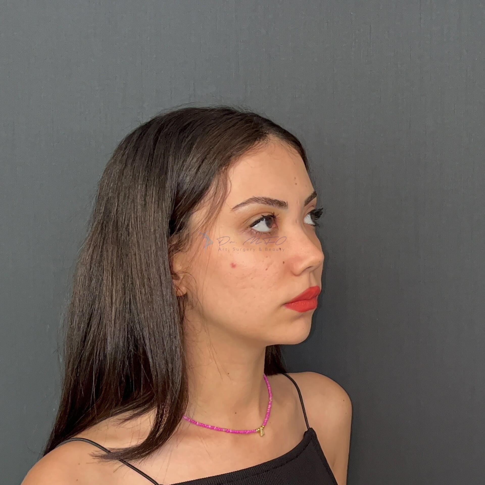 Rhinoplasty - Dr. MFO - FFS Surgeon in Turkey