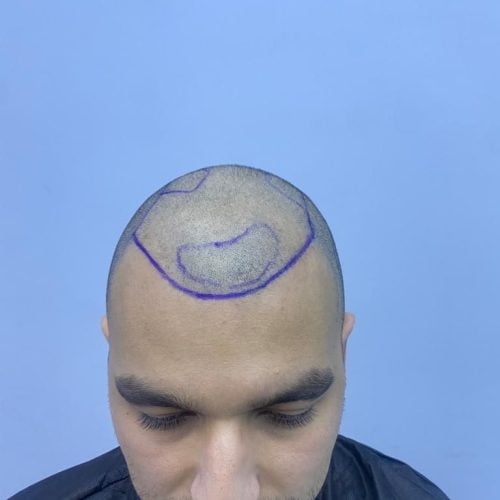 Hair Transplant in Turkey - Dr. MFO - FFS Surgeon in Turkey