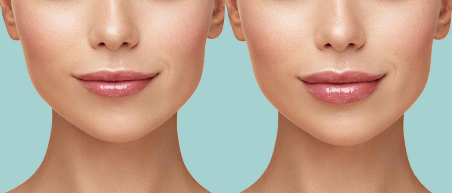 Lip Lift Cost in Turkey: Here are the Country-by-Country Comparisons ...