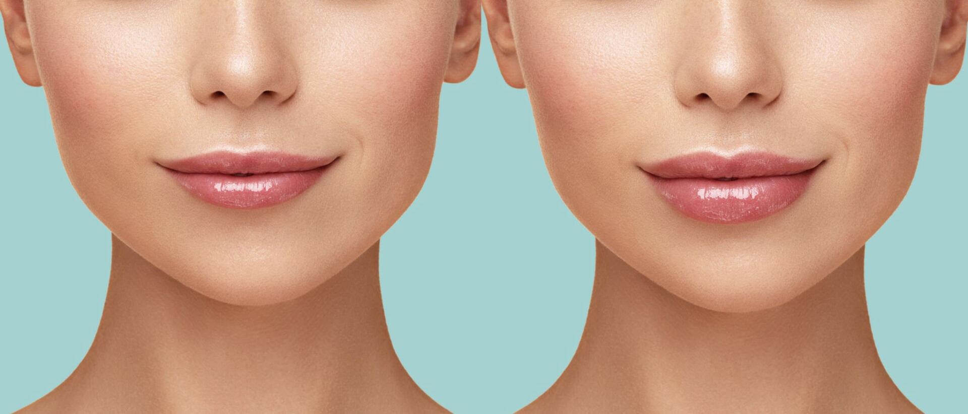 Lip Lift Cost in Turkey: Here are the Country-by-Country Comparisons ...