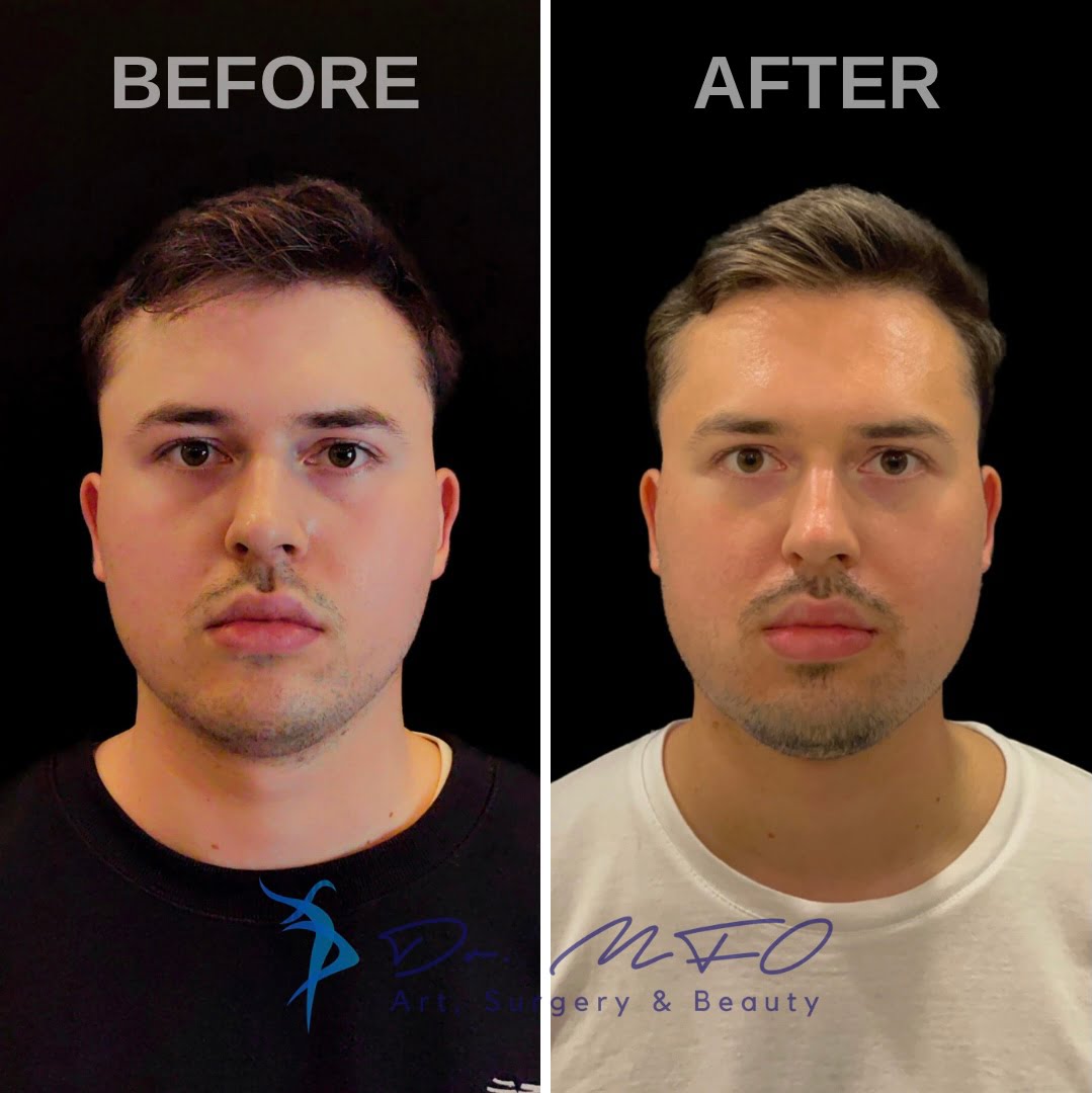 Facial Masculinization Surgery - Dr. MFO - FFS Surgeon in Turkey