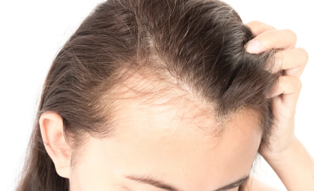 Línea Del Cabello En Forma De M Tintes Para Hombres: Colores En