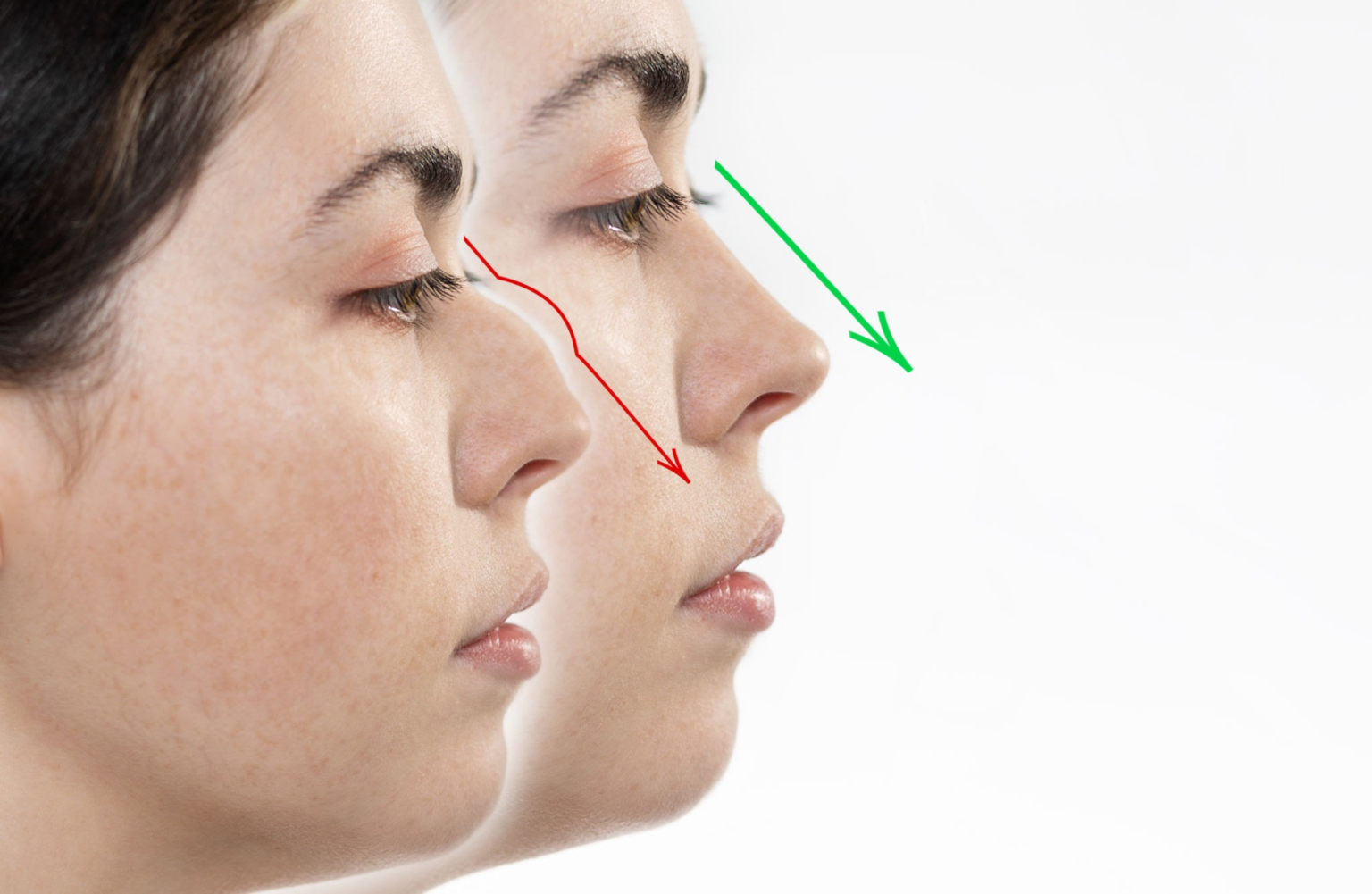 Rhinoplasty For Facial Feminization: Nose Changes Explained