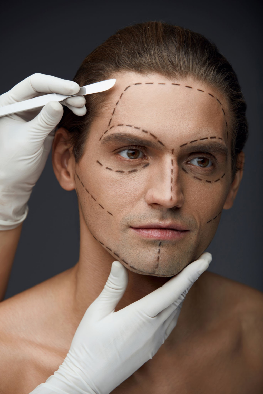 Is facial masculinization permanent?