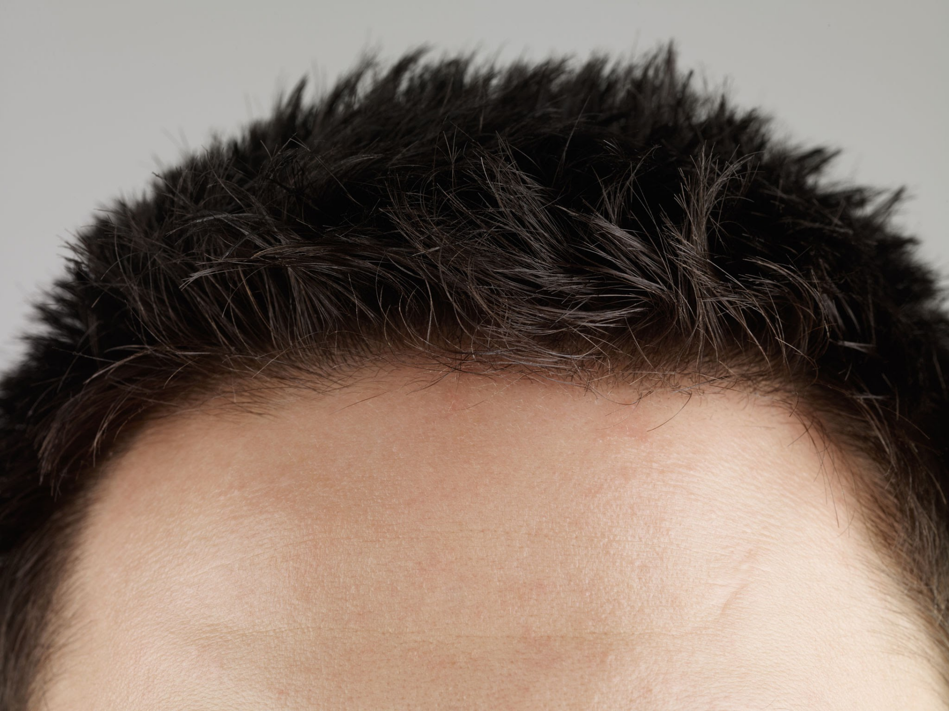 Forehead Masculinization Surgery: Complete Guide 2024
