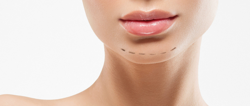 Genioplasty Surgery - Dr. MFO - FFS Surgeon in Turkey